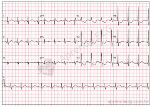 Infarto da Parede Lateral: O Papel do ECG nas Oclusões da CX - Aprenda ECG