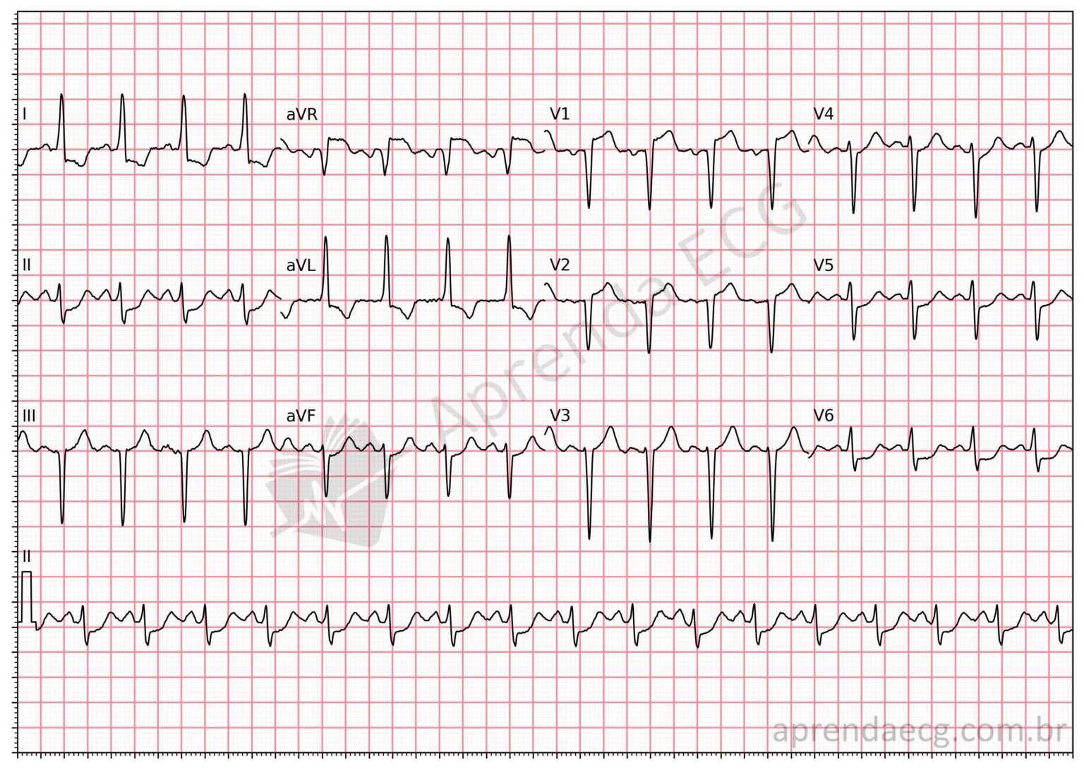 Isquemia Circunferencial - Aprenda ECG