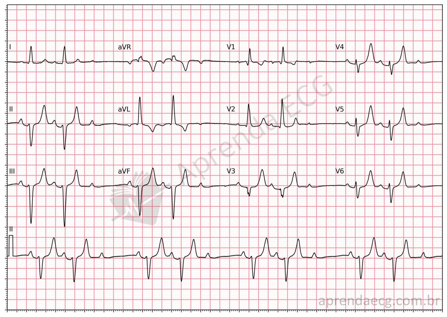 Bloqueios Atrioventriculares - Aprenda ECG