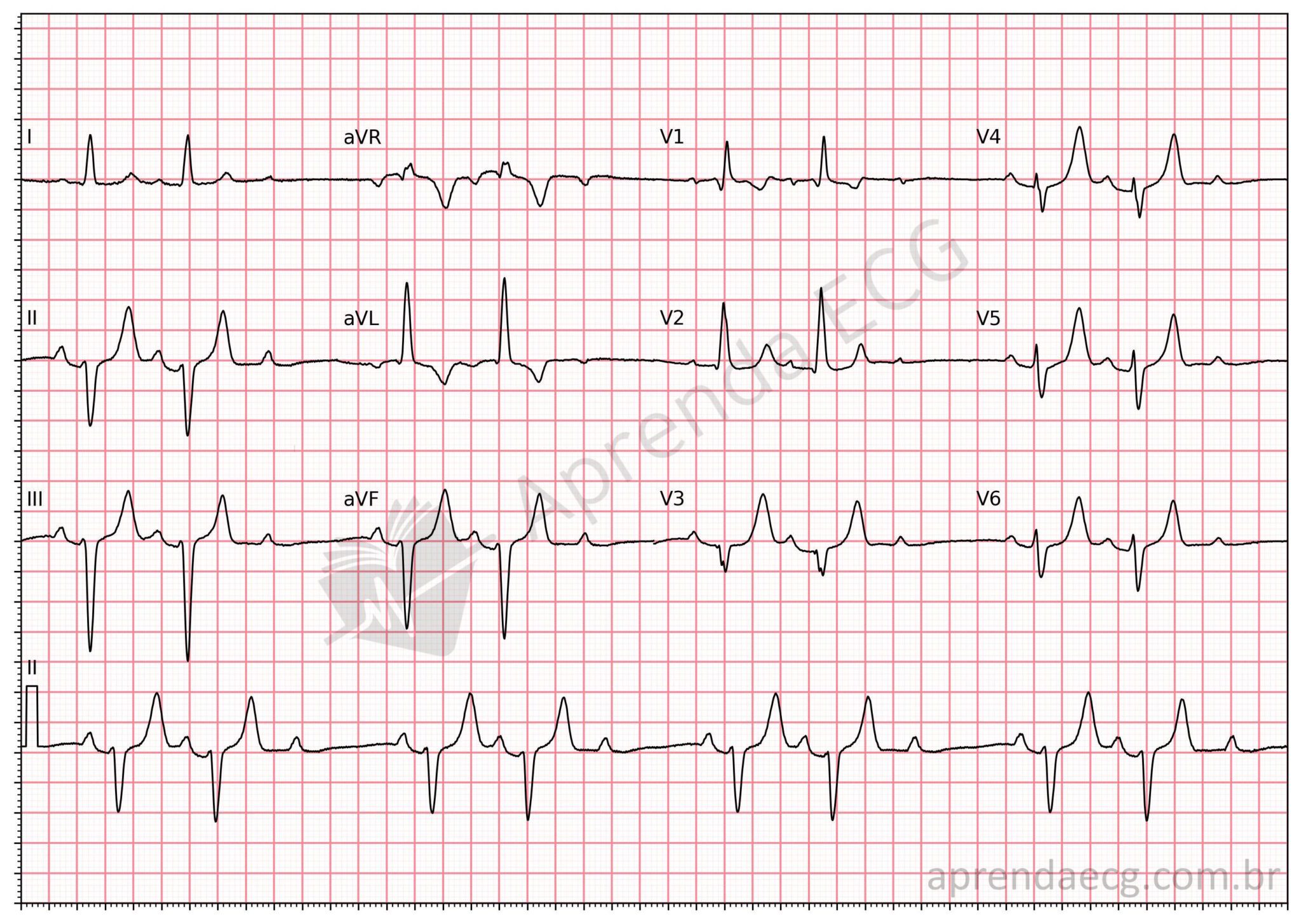 Bloqueios Atrioventriculares - Aprenda ECG