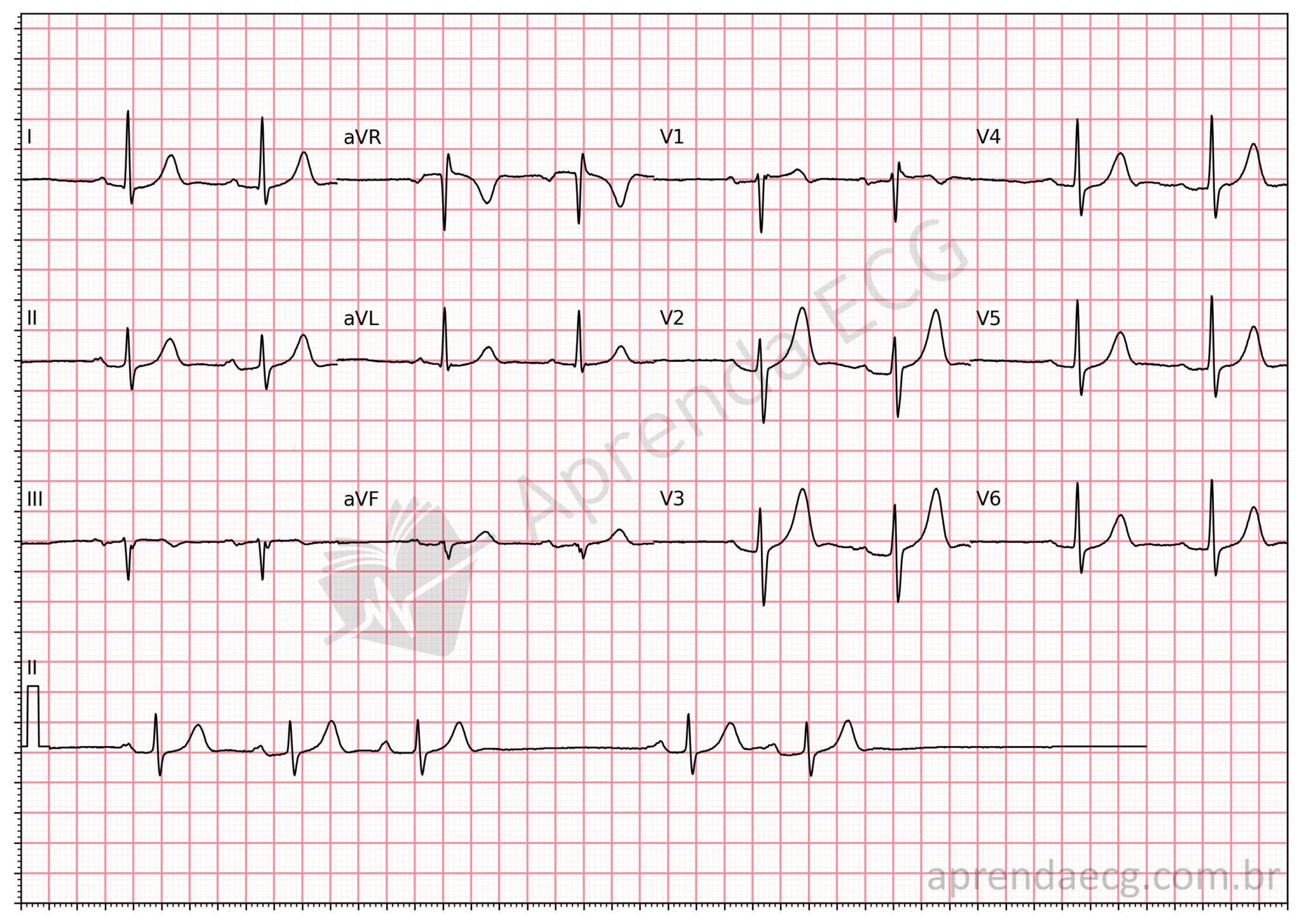 Parada Sinusal - Aprenda ECG