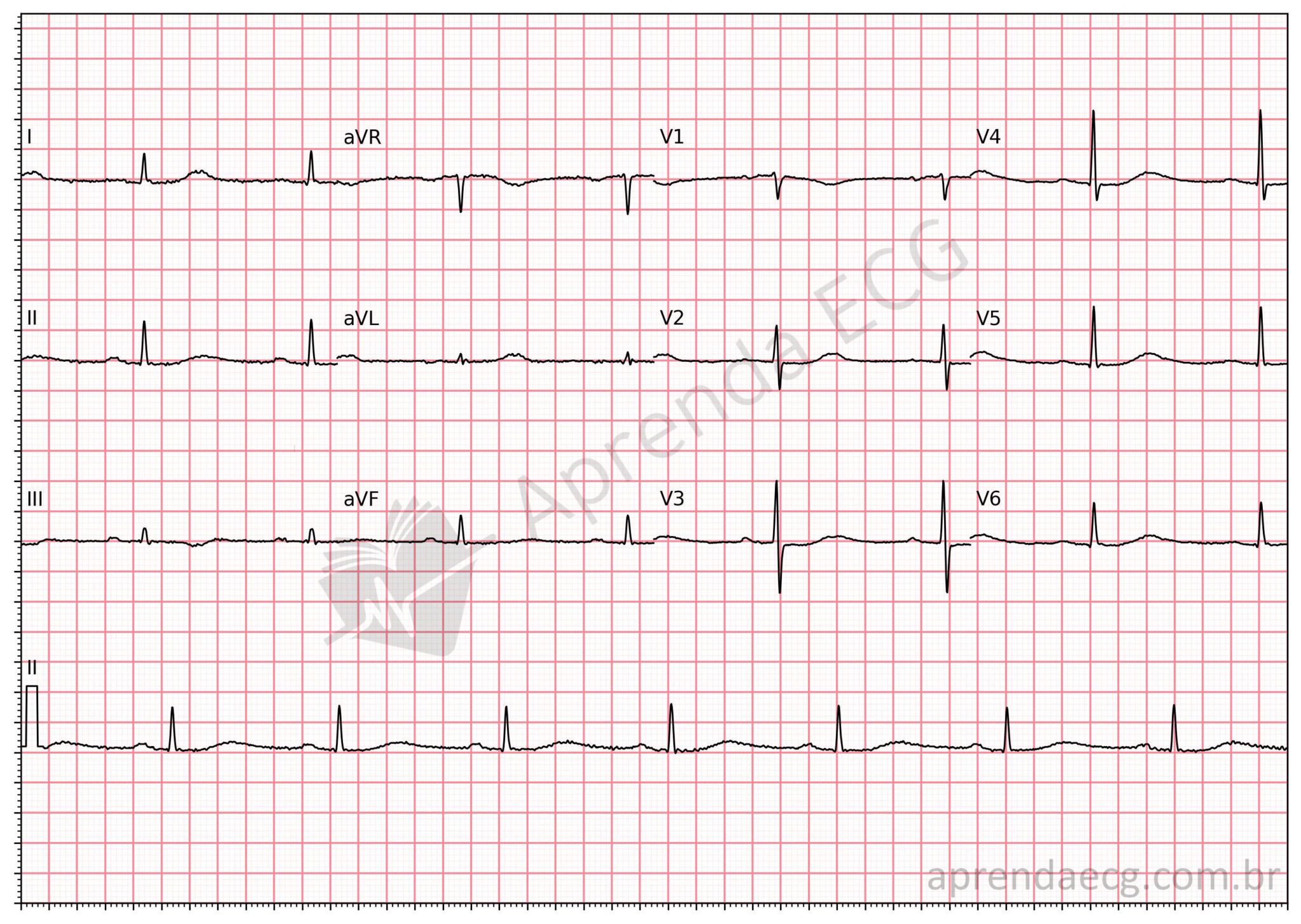 Intervalo QT - Aprenda ECG