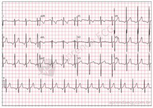 Ritmo Atrial Ectópico - Aprenda ECG