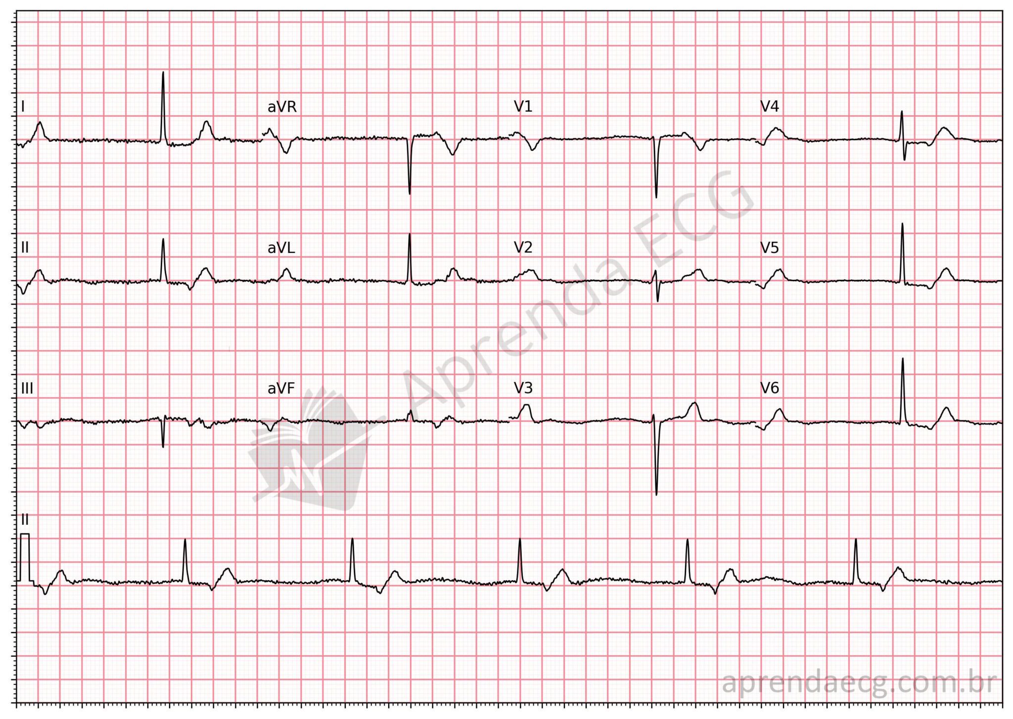 Ritmos de Escape - Aprenda ECG