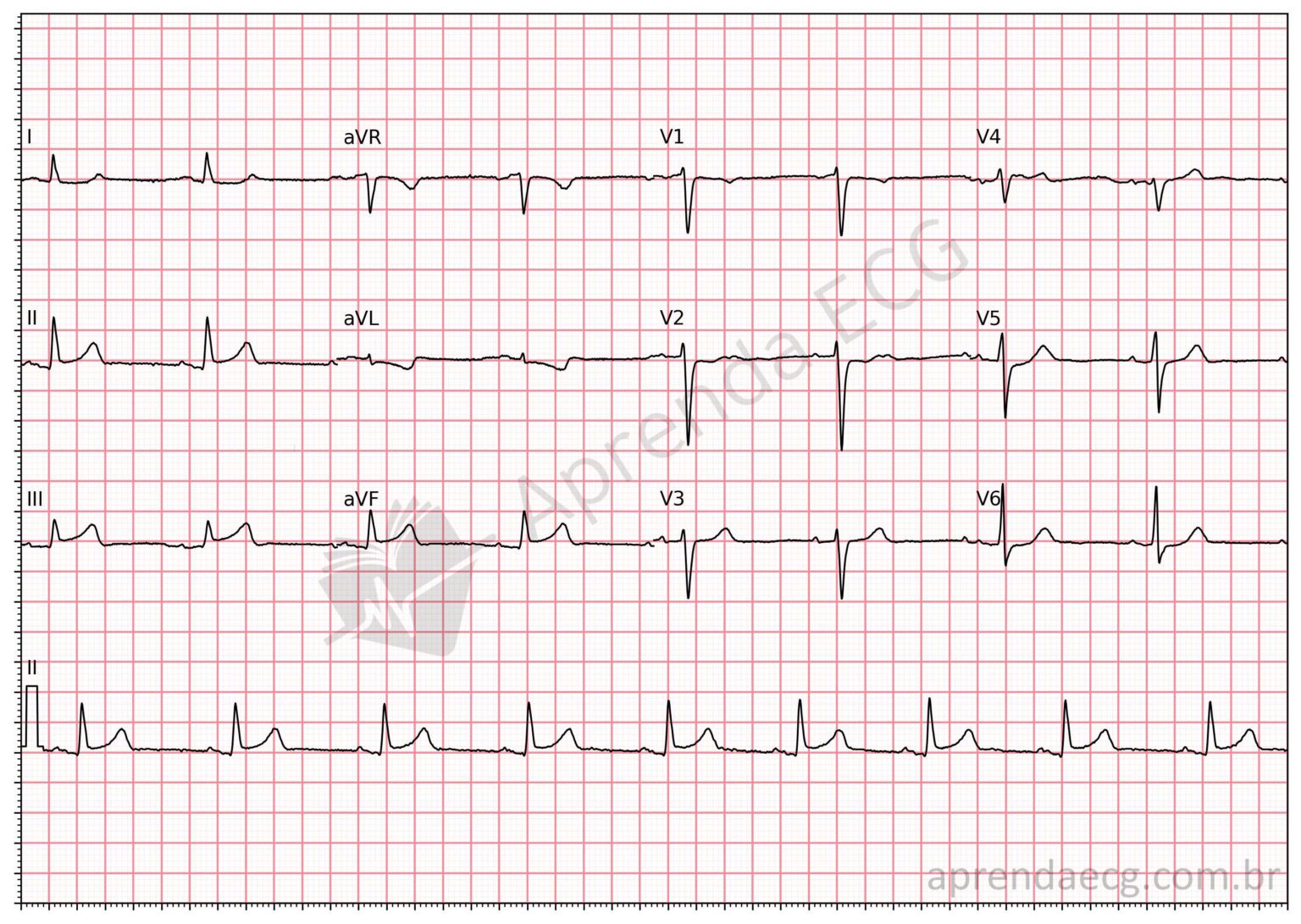 Tudo que Você Precisa Saber sobre o Supradesnivelamento do Segmento ST - Aprenda ECG