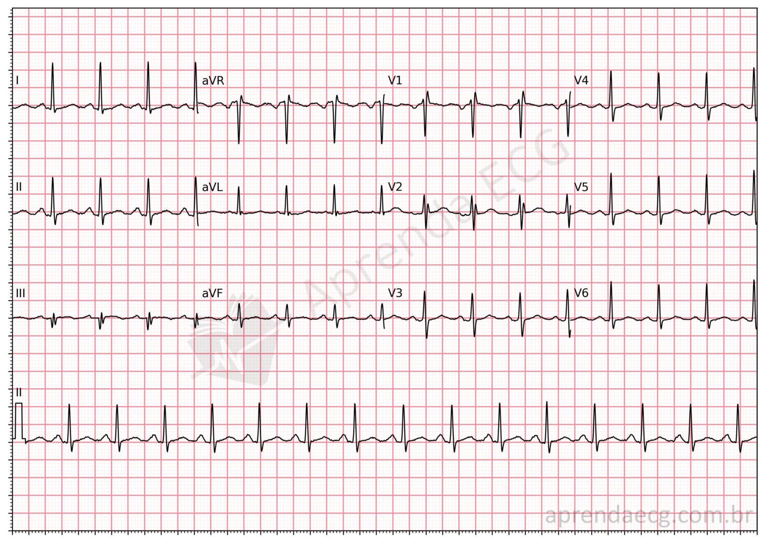 Taquicardia Sinusal - Aprenda ECG