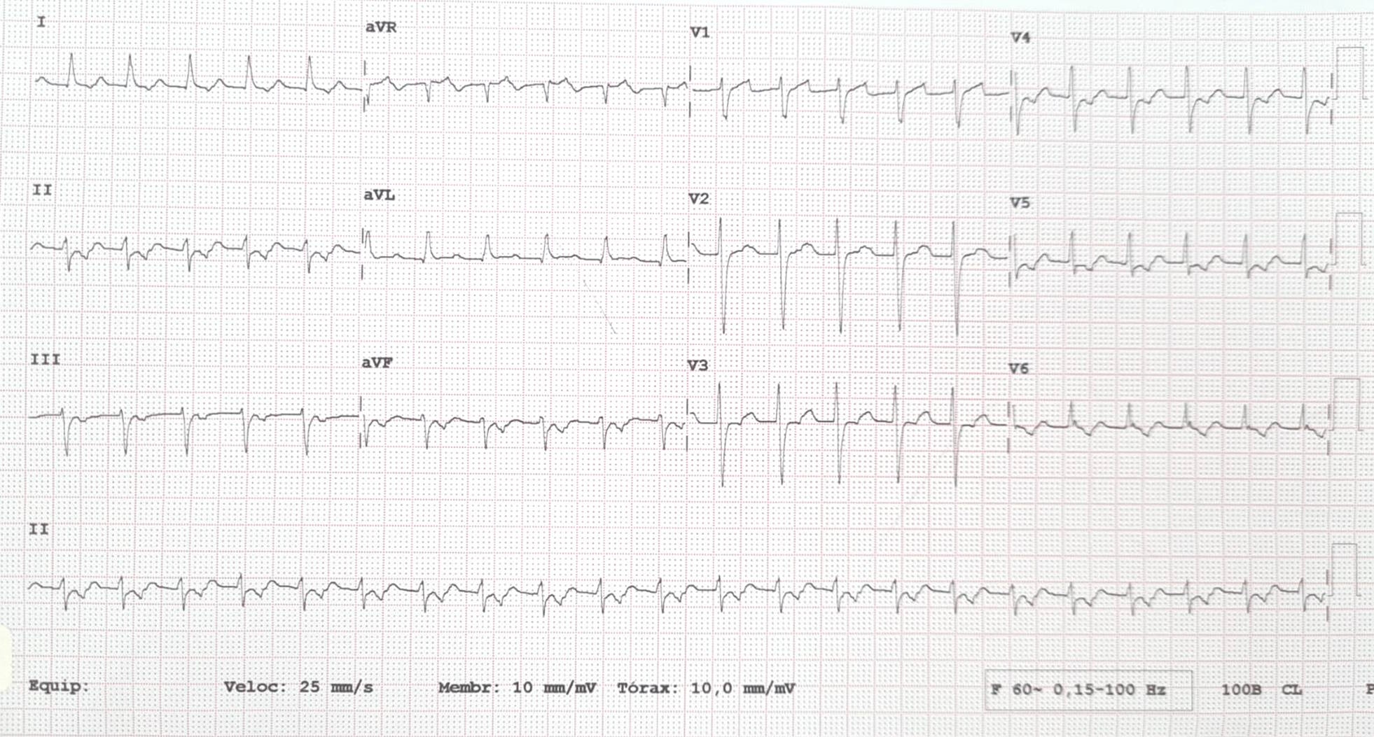 Taquicardia por Reentrada Nodal vs Taquicardia por Reentrada Atrioventricular Ortodrômica ...