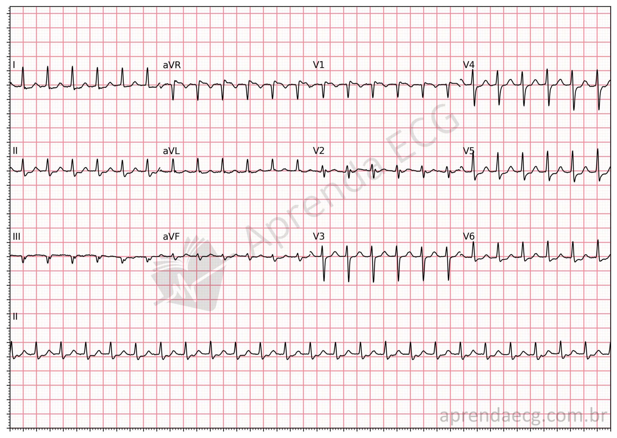 Taquicardia por Reentrada Nodal vs Taquicardia por Reentrada Atrioventricular Ortodrômica ...