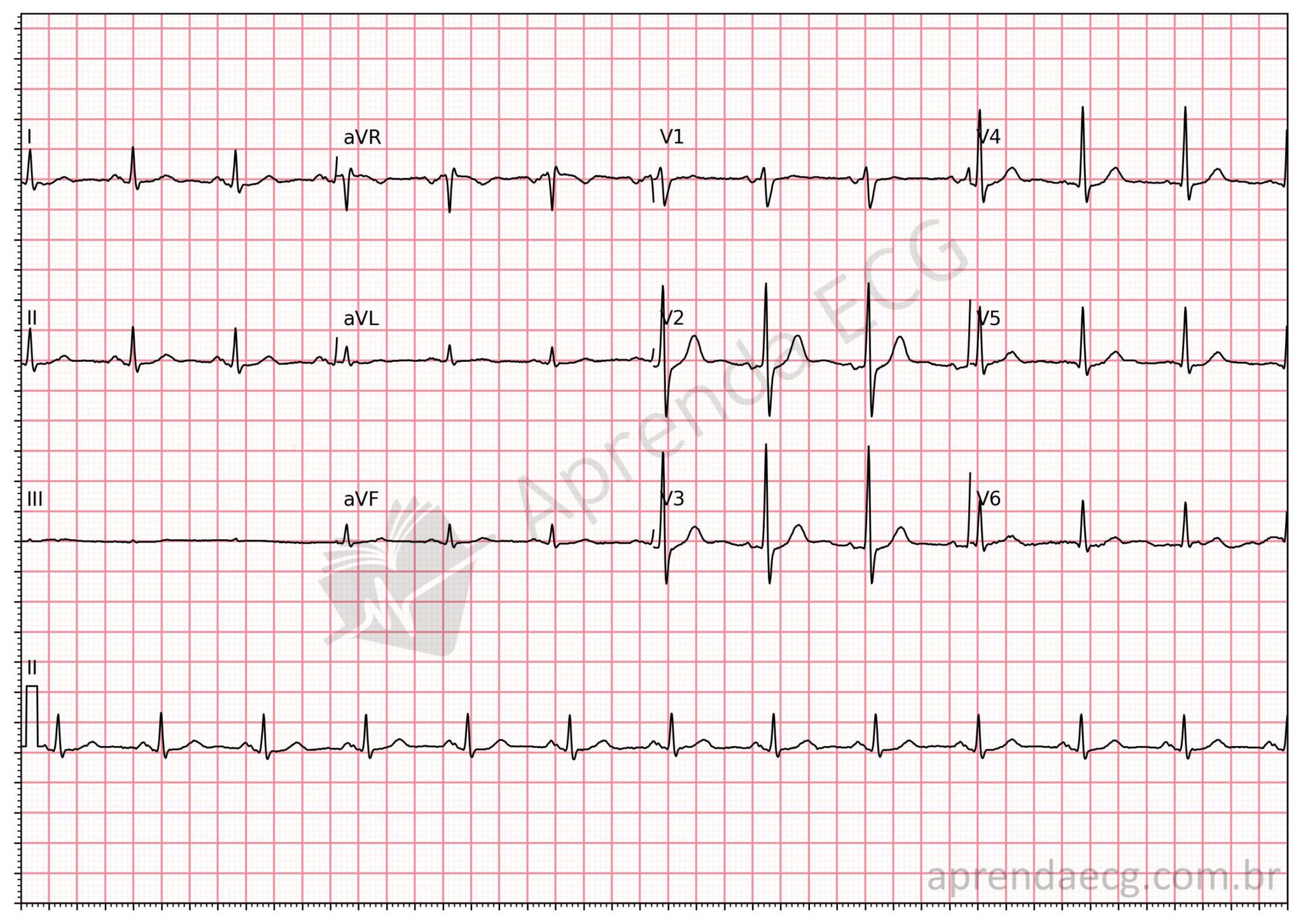 Trocas de Eletrodos - Aprenda ECG