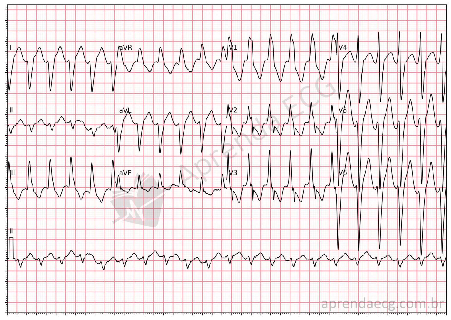 Taquicardia Ventricular - Aprenda ECG