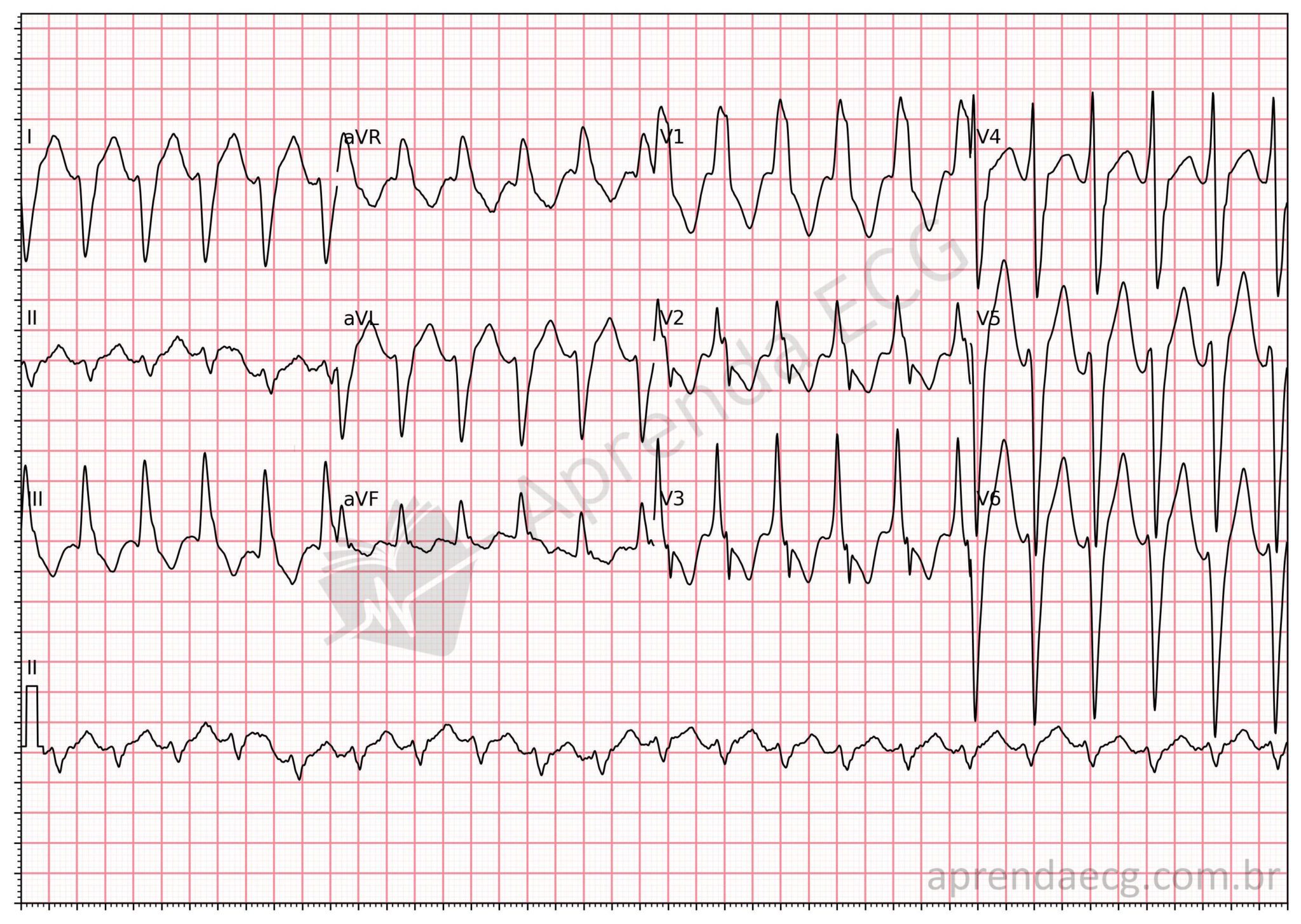 Taquicardia Ventricular - Aprenda ECG