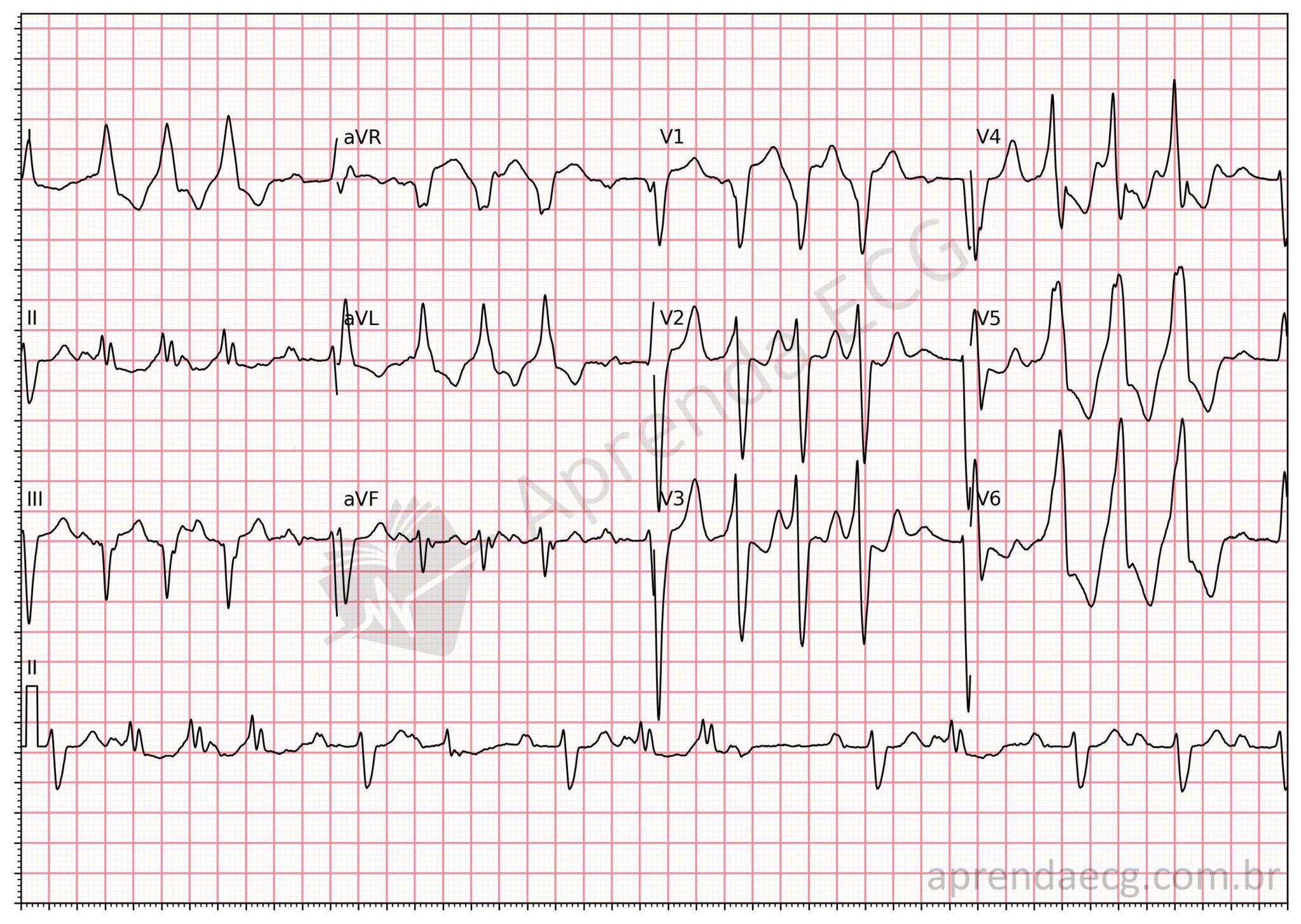 Taquicardia Ventricular - Aprenda ECG