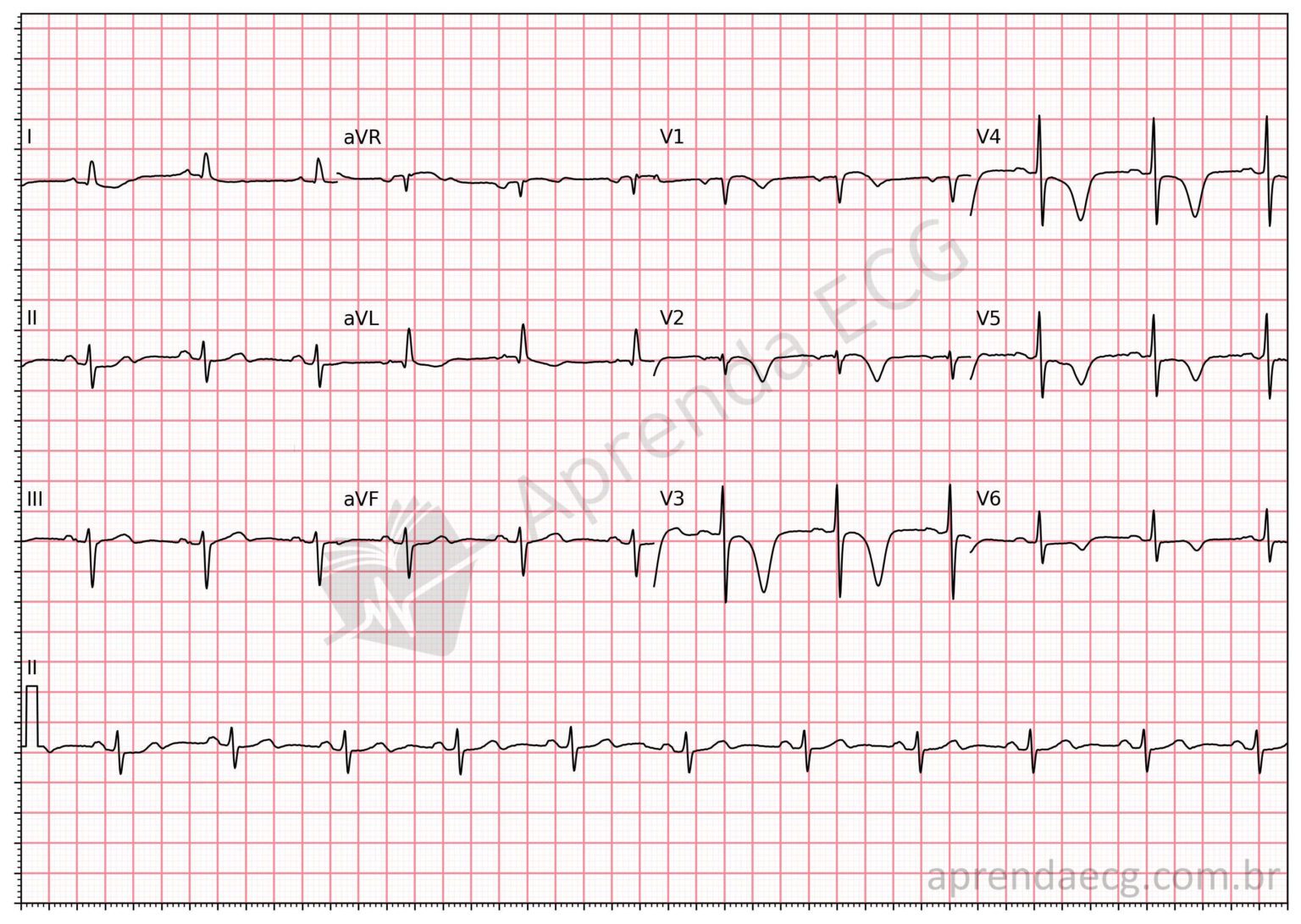 Síndrome de Wellens - Aprenda ECG