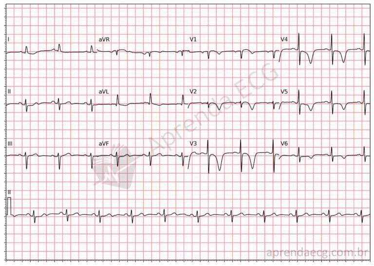 Síndrome de Wellens - Aprenda ECG