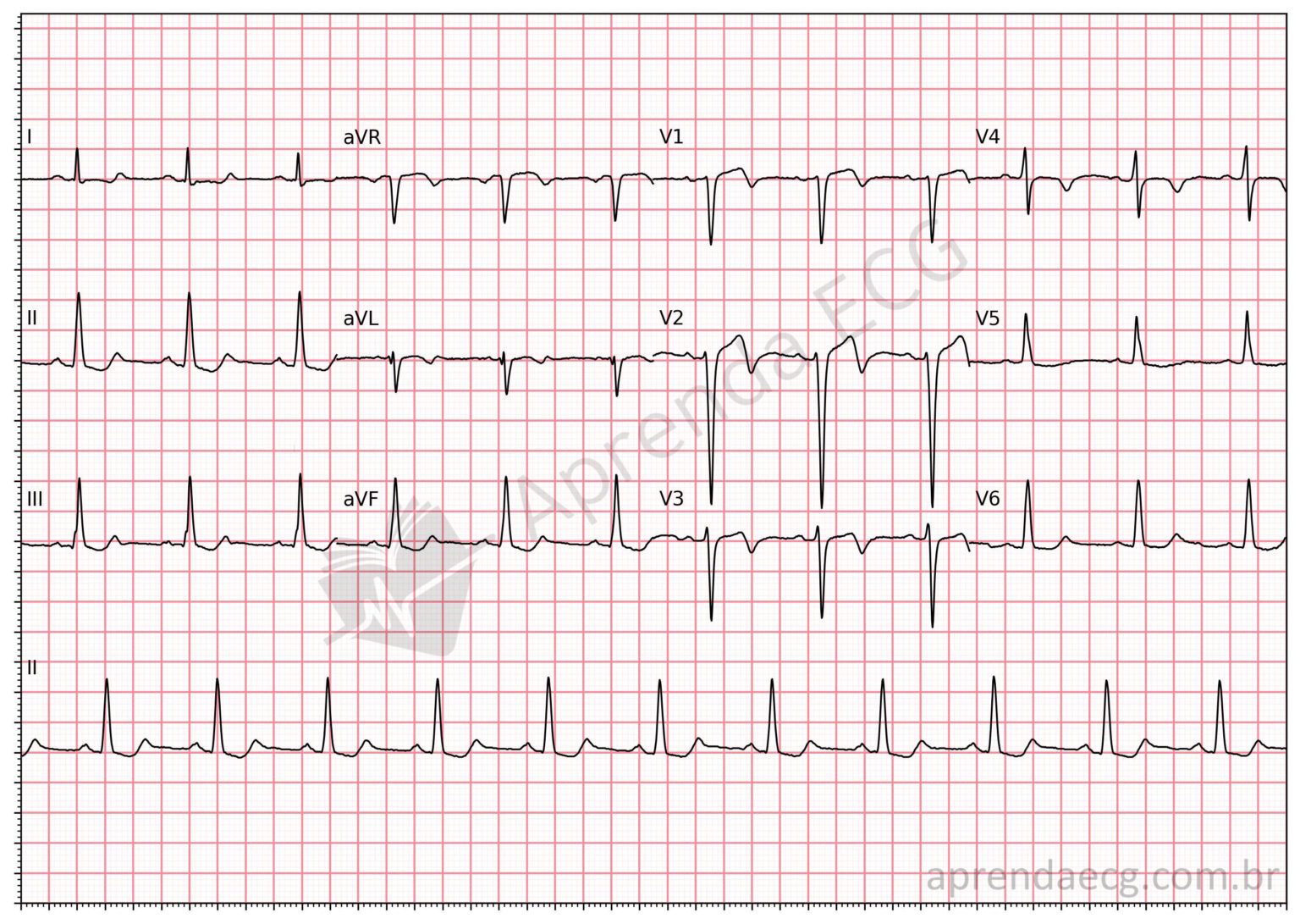Síndrome de Wellens - Aprenda ECG