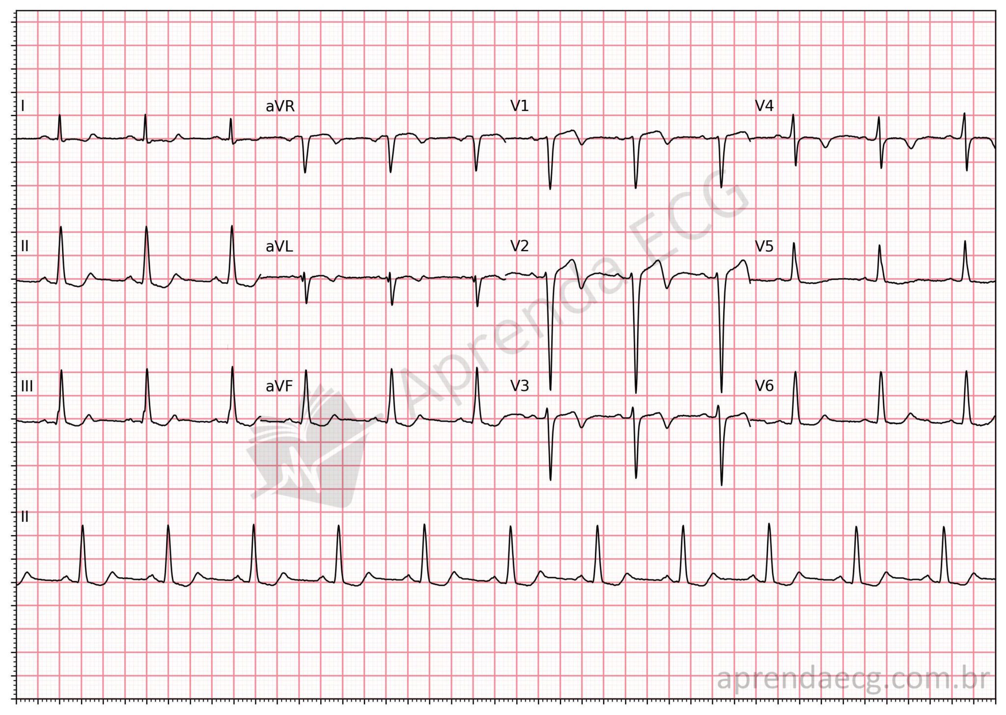 Síndrome de Wellens - Aprenda ECG