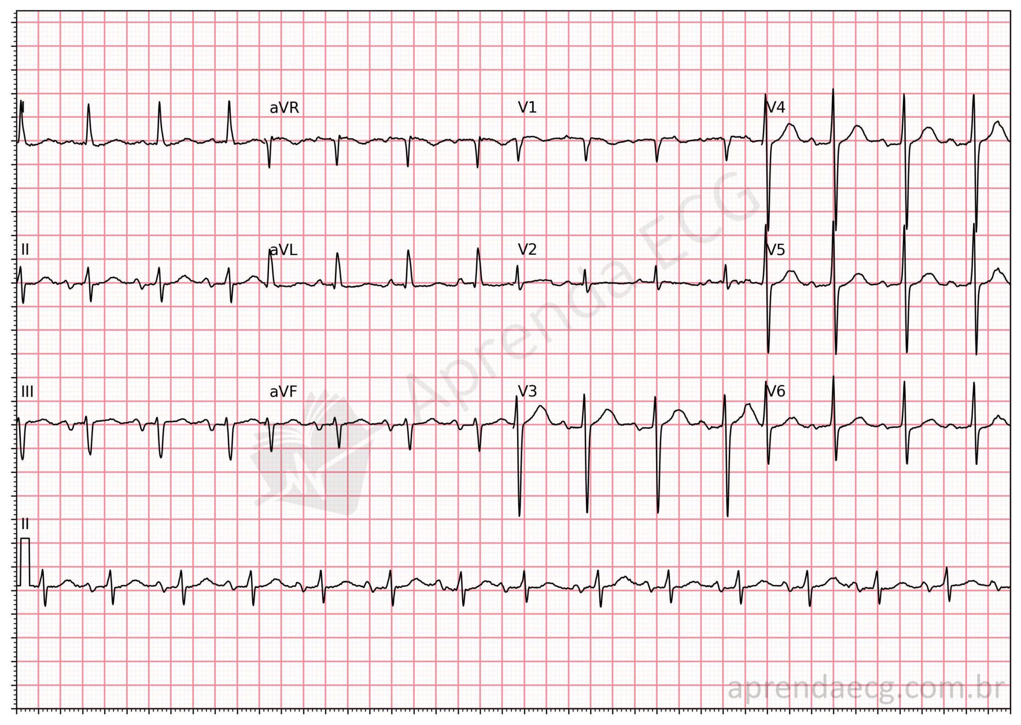 Bloqueios Interatriais: Conceito, Classificação e Implicações Clínicas