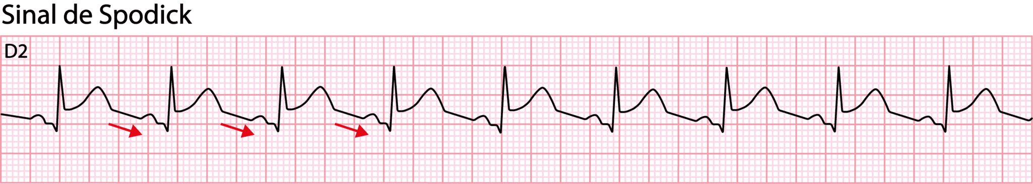 O Sinal de Spodick - Aprenda ECG
