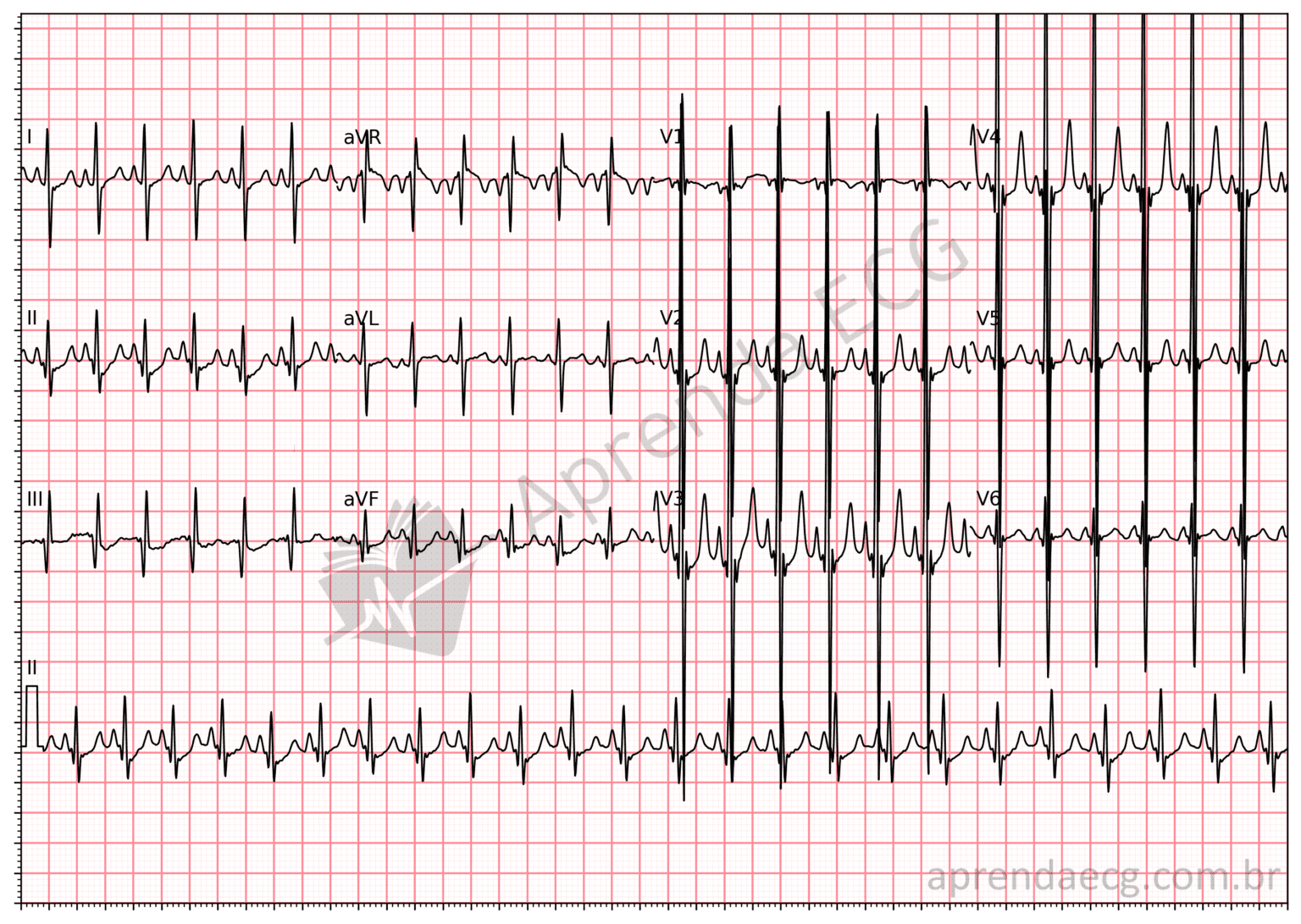 Sobrecarga Biventricular - Aprenda ECG