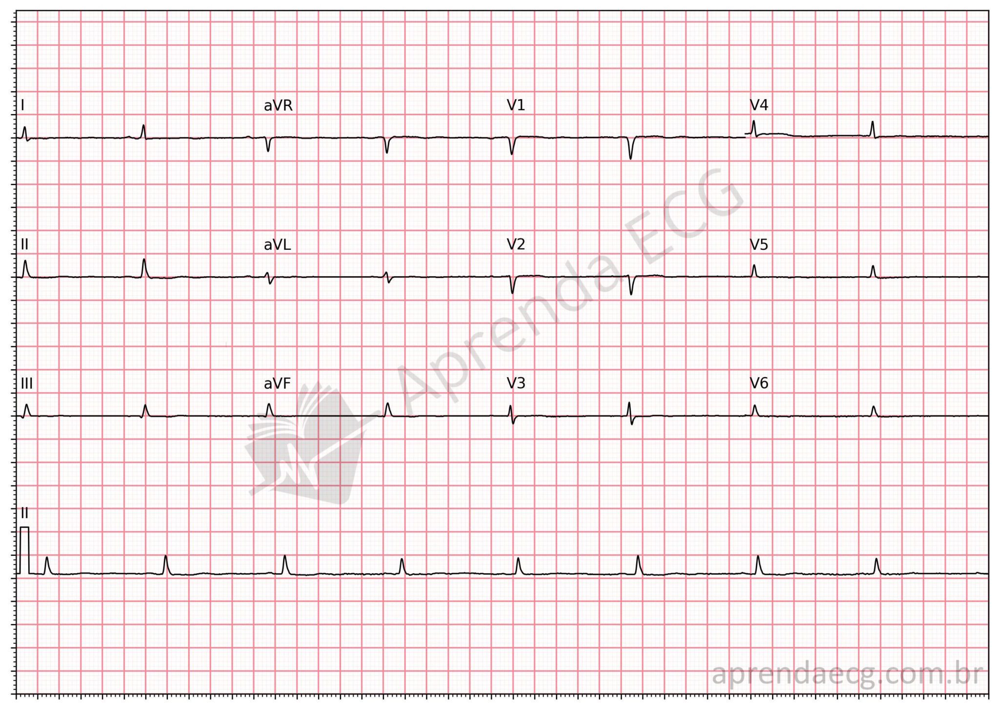 Baixa Voltagem do QRS - Aprenda ECG