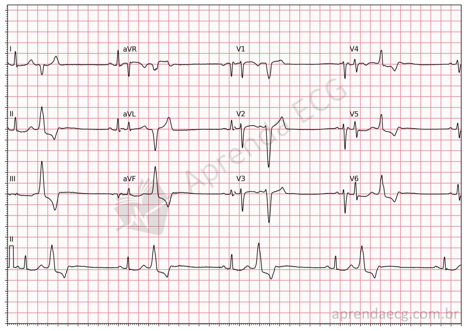Extrassístole Ventricular - Aprenda ECG