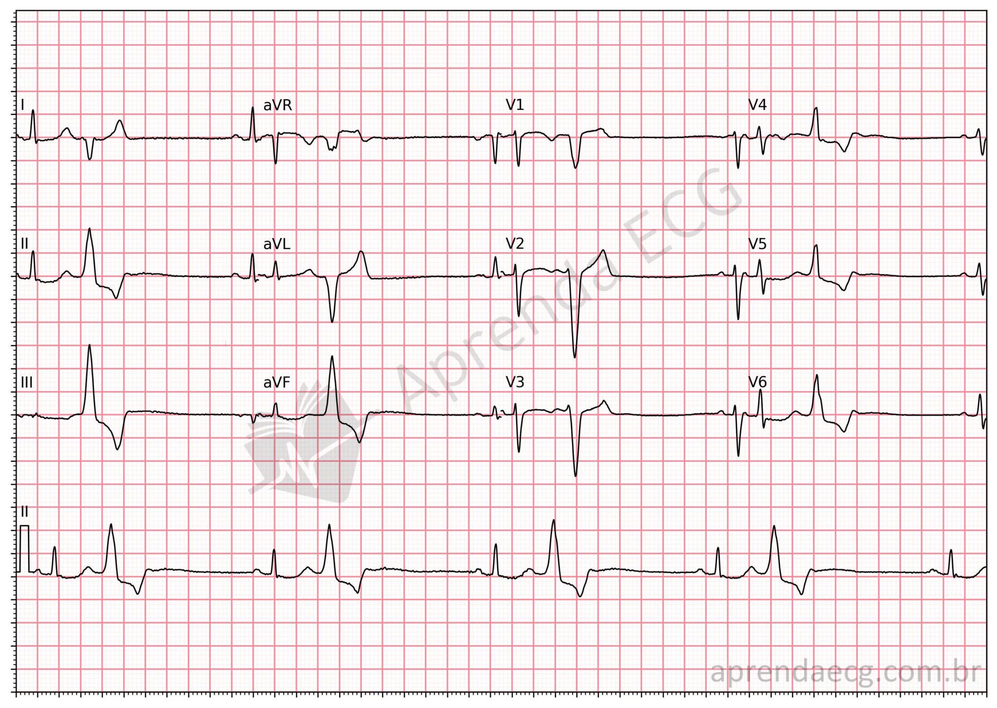 Extrassístole Ventricular - Aprenda ECG | Doctor Quest