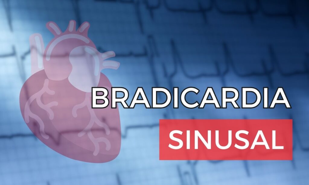 Bradicardia Sinusal - Aprenda ECG