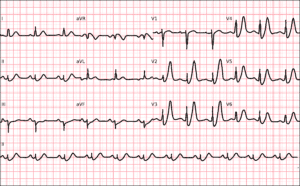 Padrão de "de Winter" - Aprenda ECG