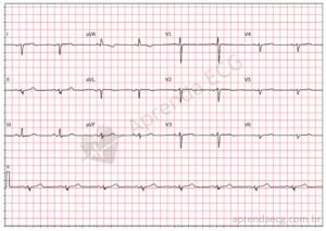 Dextrocardia - Aprenda ECG