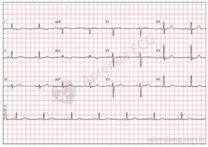 Dextrocardia - Aprenda ECG