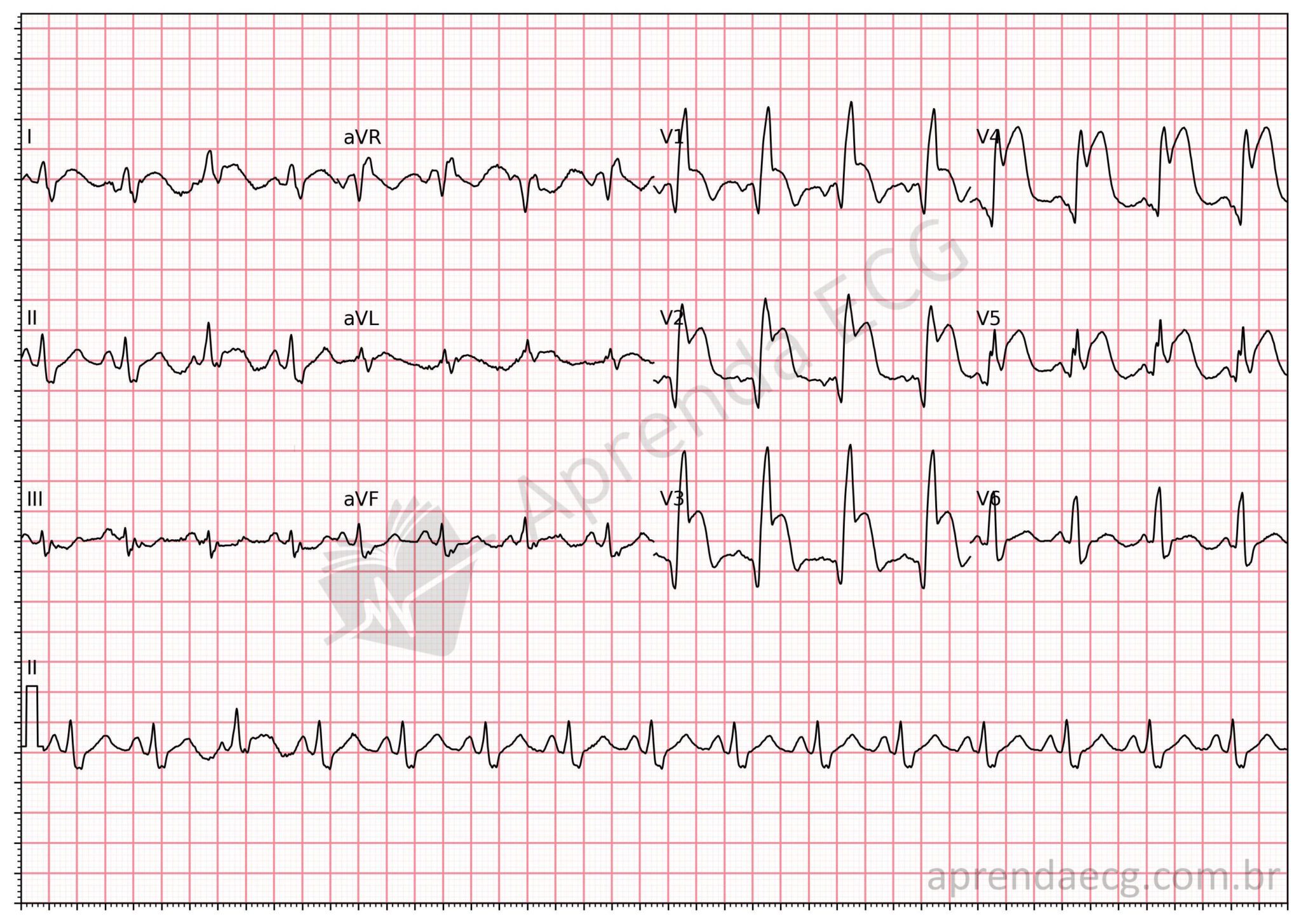 IAM na presença de BRD - Aprenda ECG