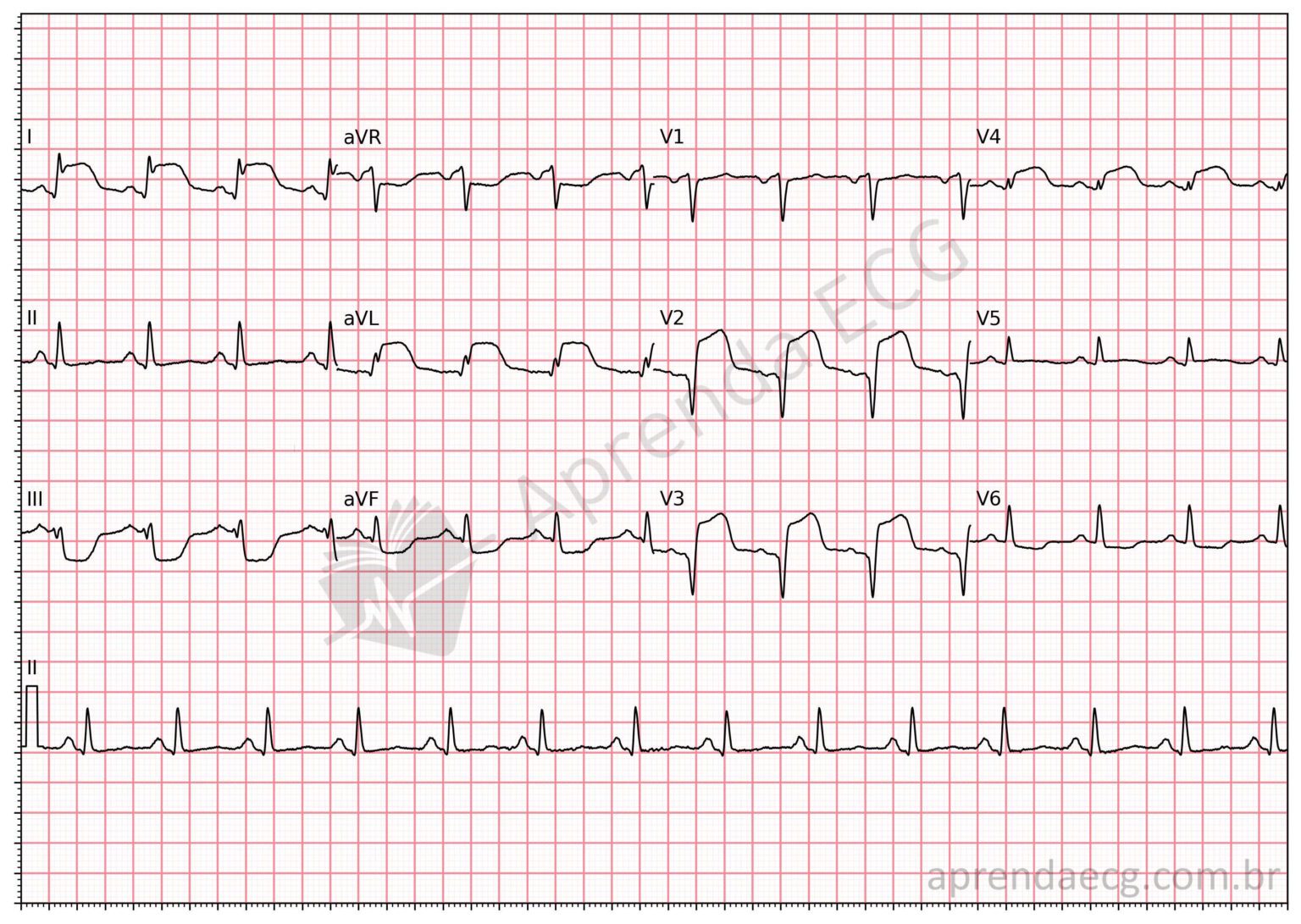 Tudo que Você Precisa Saber sobre o Supradesnivelamento do Segmento ST - Aprenda ECG