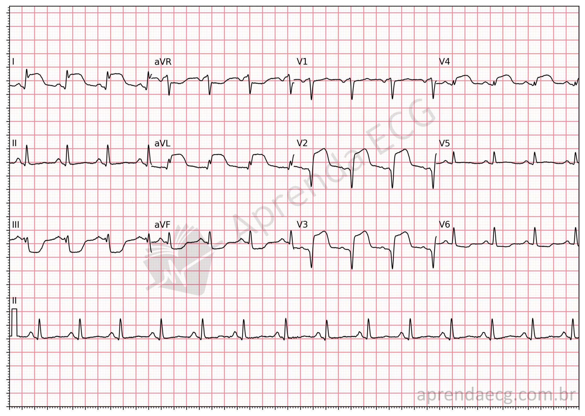 Padrão de Supradesnivelamento de ST em Lápide (Tombstone) - Aprenda ECG