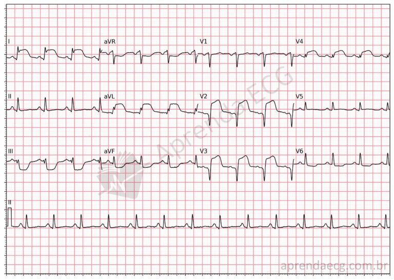 Padrão de Supradesnivelamento de ST em Lápide (Tombstone) - Aprenda ECG