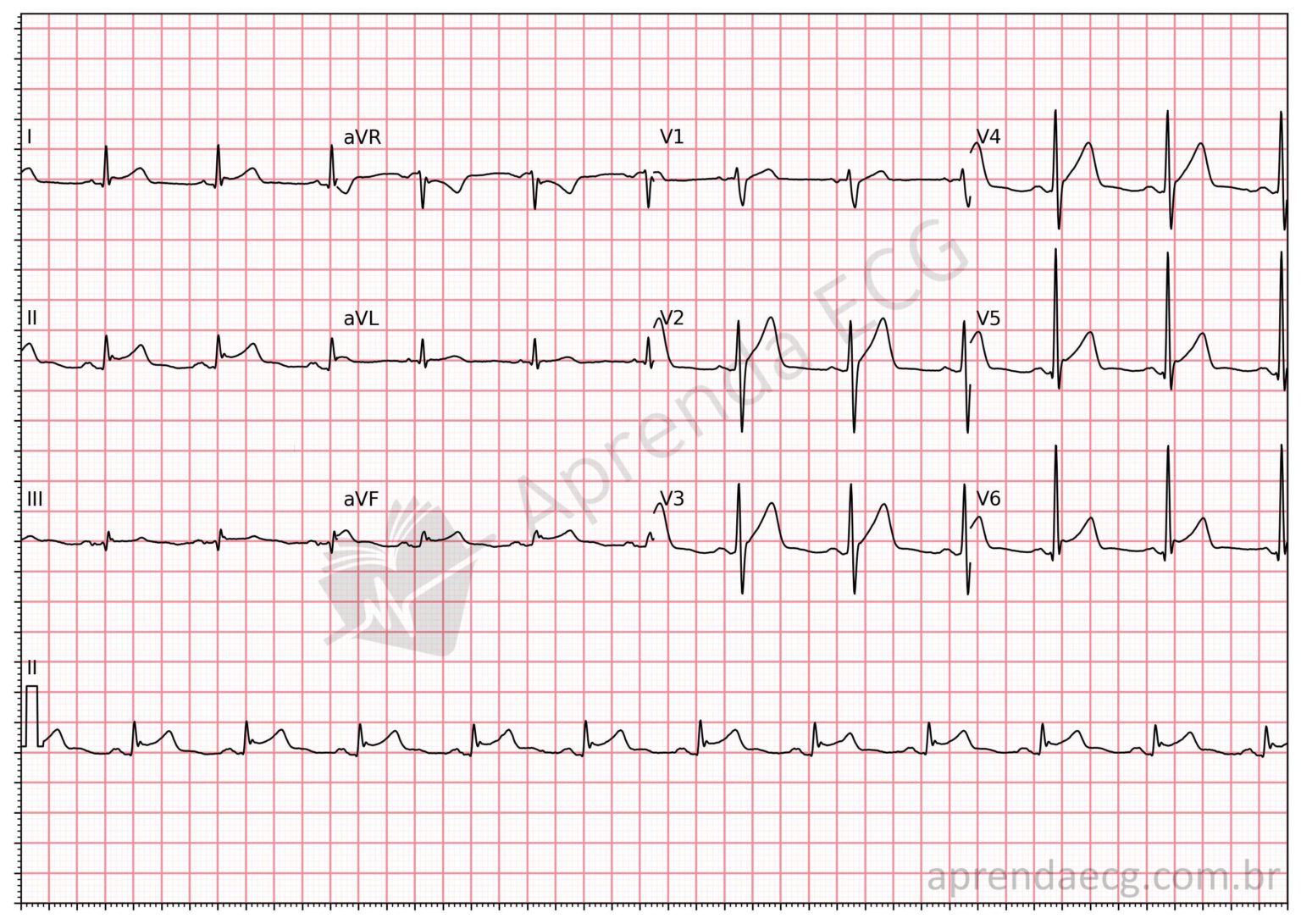 Pericardite Aguda - Aprenda ECG