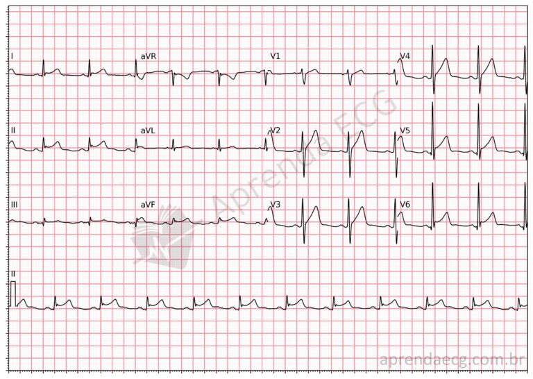 Pericardite Aguda - Aprenda ECG