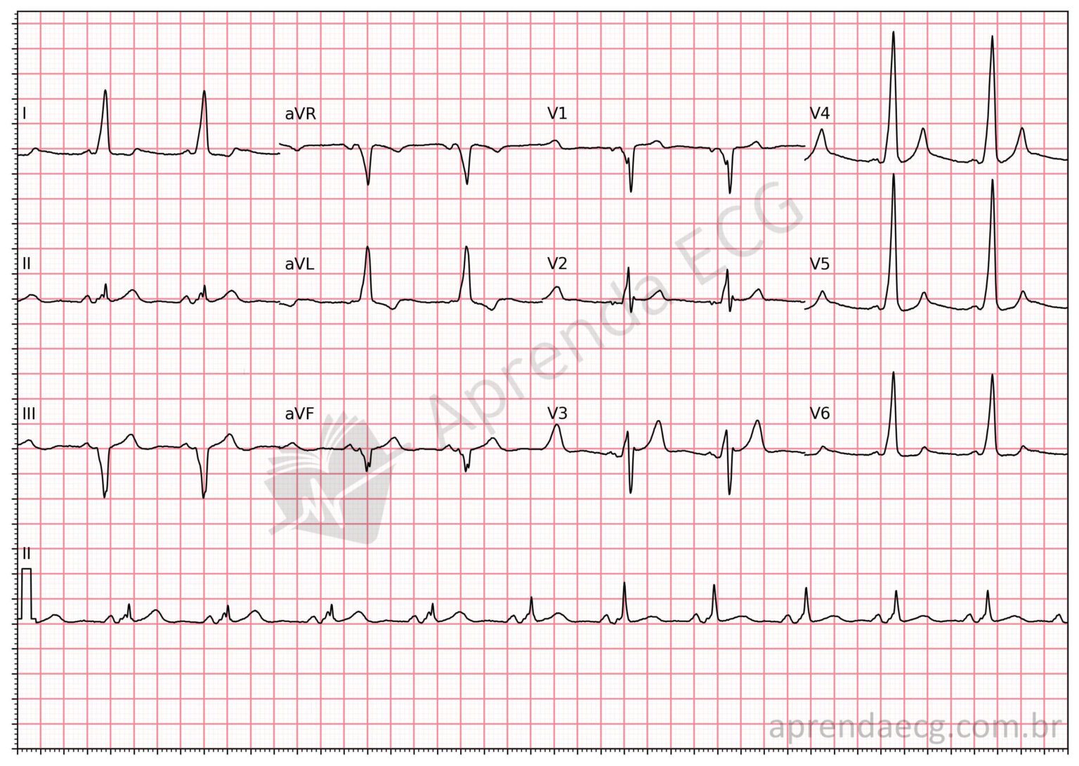 Pré-excitação Ventricular - Aprenda ECG