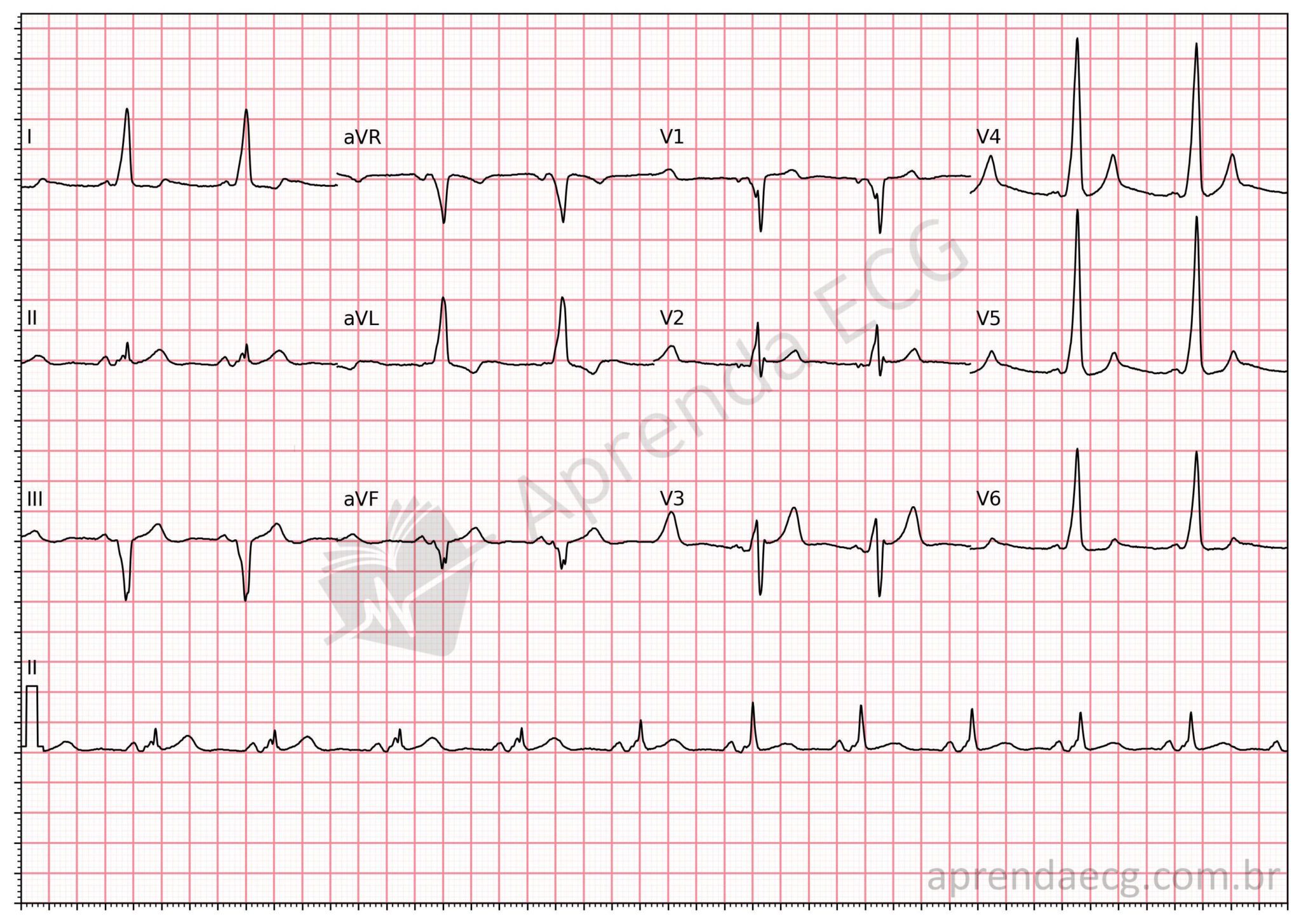 Pré-excitação Ventricular - Aprenda ECG
