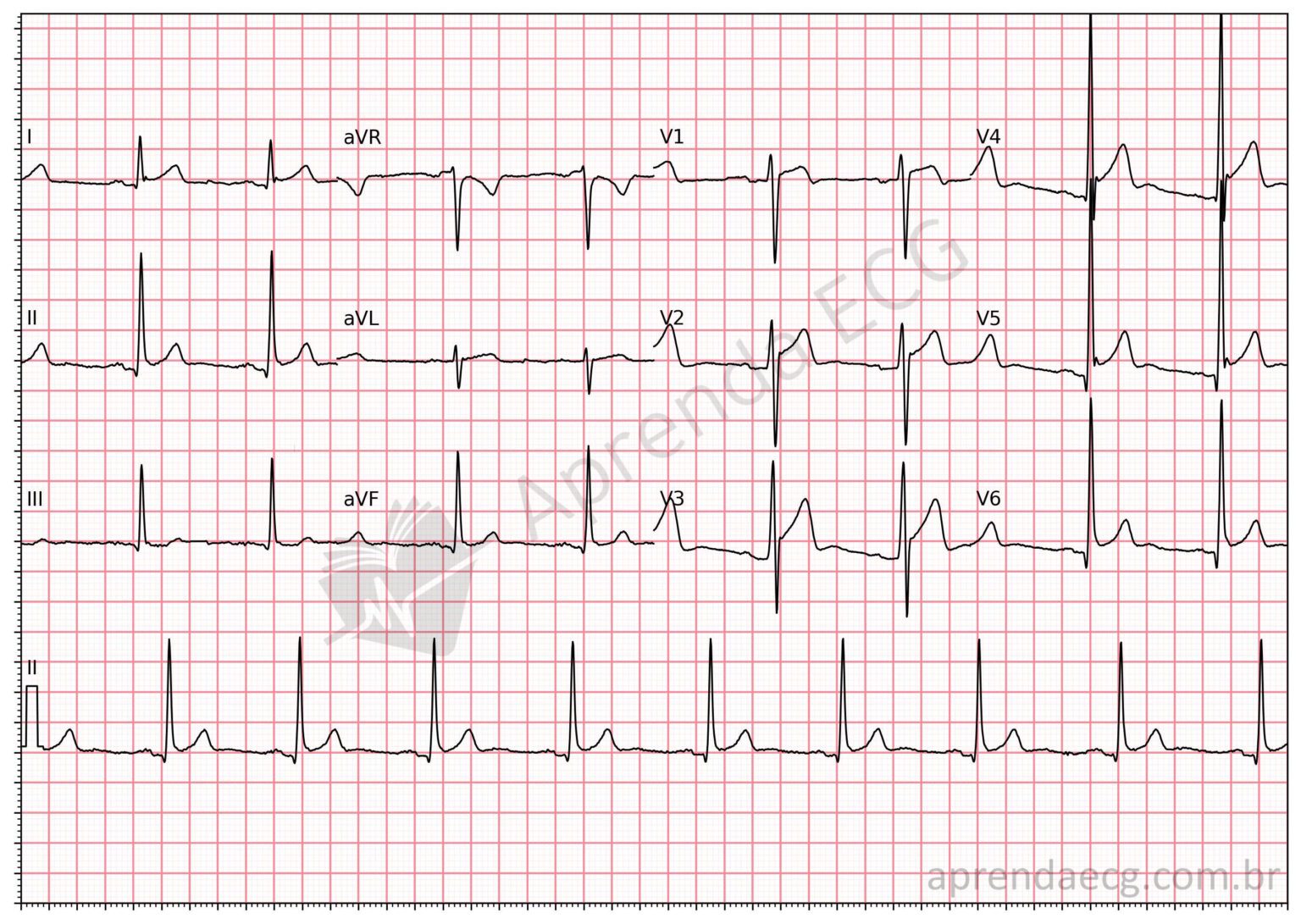 Padrão de Repolarização Precoce - Aprenda ECG