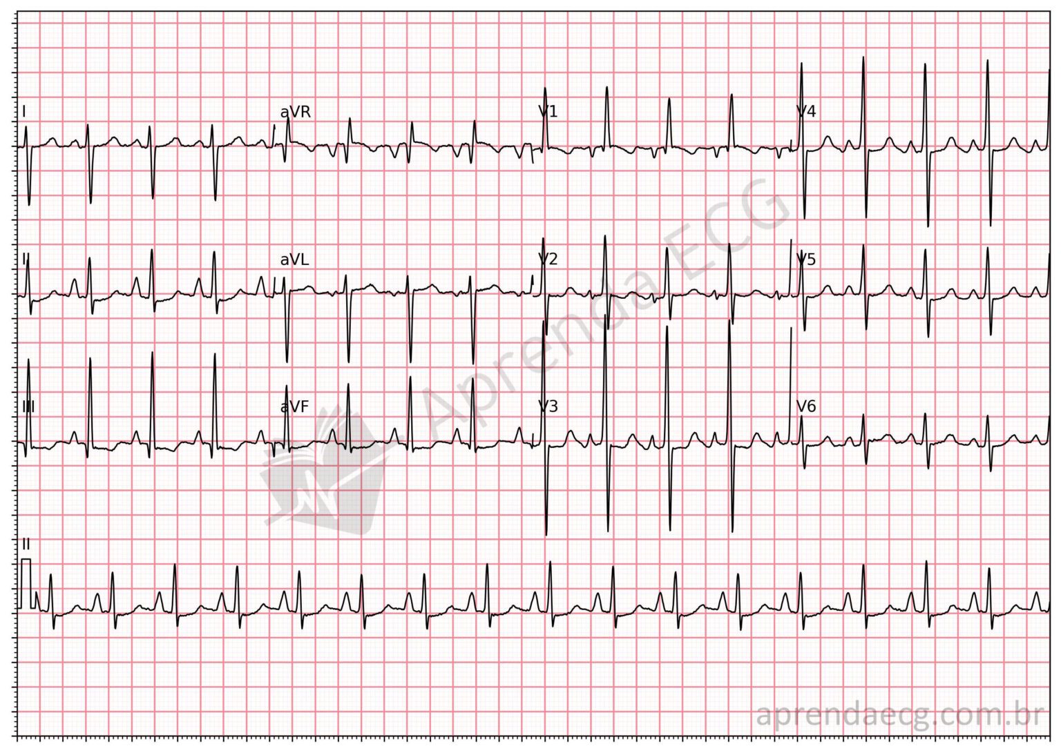 Sobrecarga Ventricular Direita - Aprenda ECG
