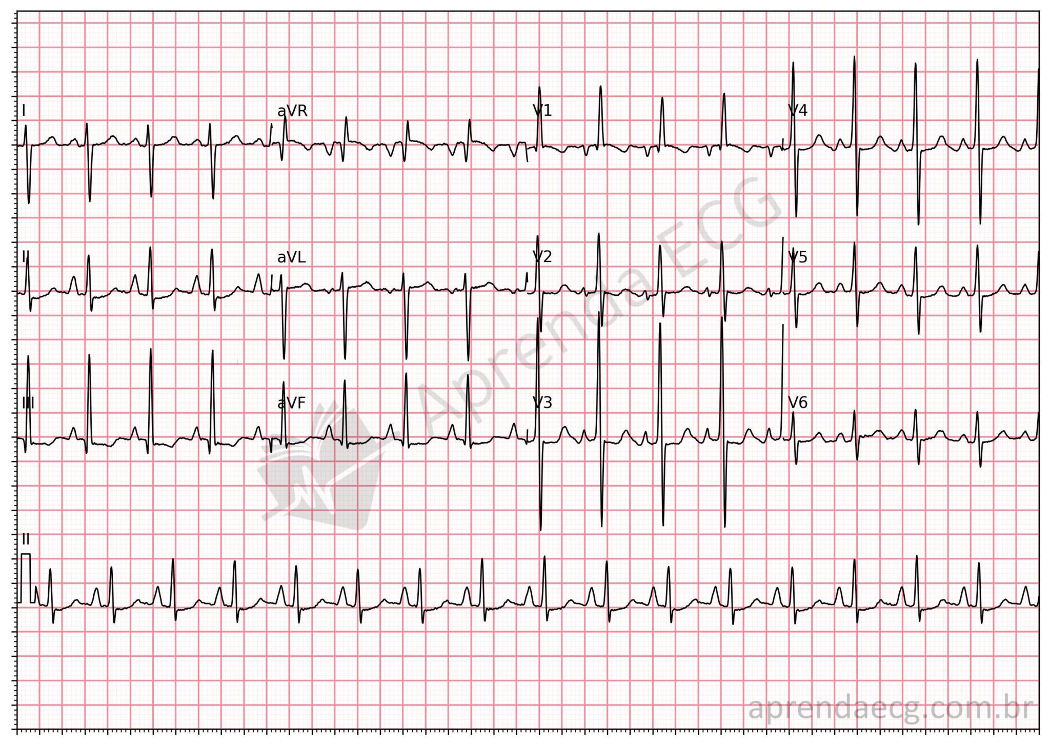 Sobrecarga Ventricular Direita - Aprenda ECG