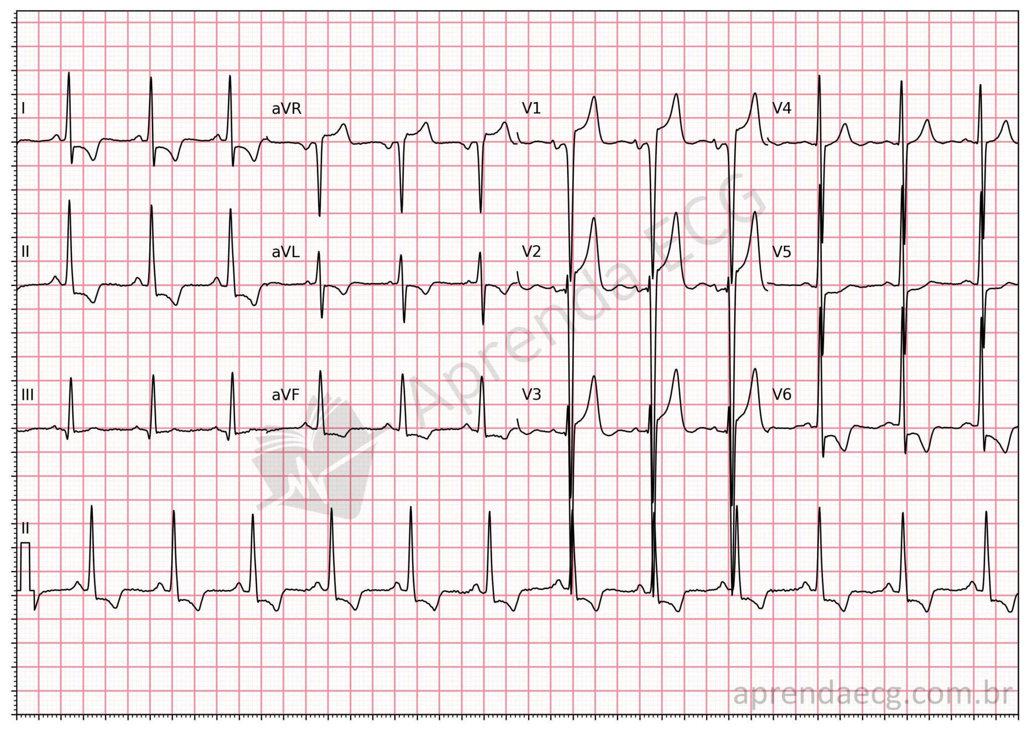 Sobrecarga Ventricular Esquerda - Aprenda ECG