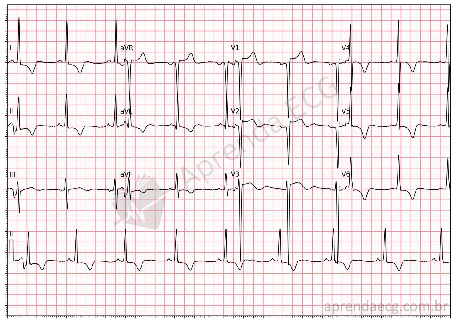 Sobrecarga Ventricular Esquerda - Aprenda ECG