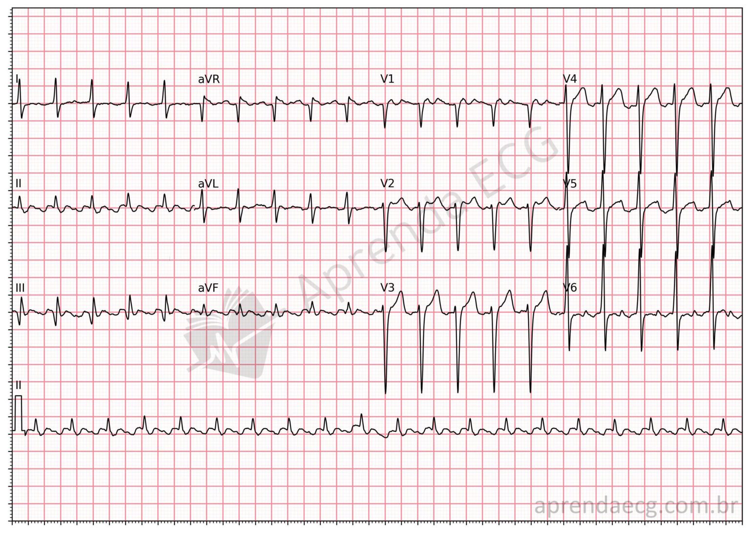 Sobrecarga Ventricular Esquerda - Aprenda ECG