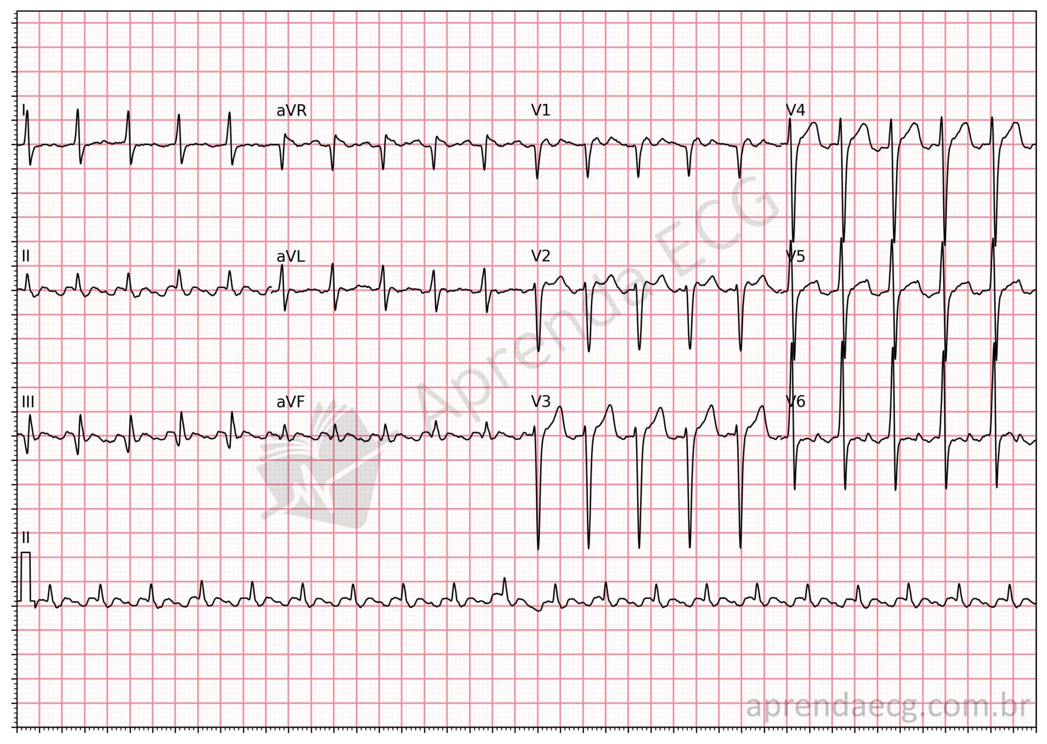 Sobrecarga Ventricular Esquerda - Aprenda ECG