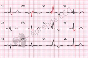 Como Reconhecer o Bloqueio de Ramo Direito no ECG - Aprenda ECG