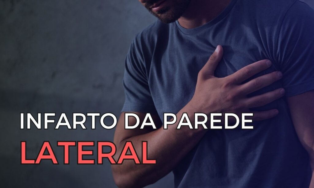 Topografia do Infarto - Aprenda ECG