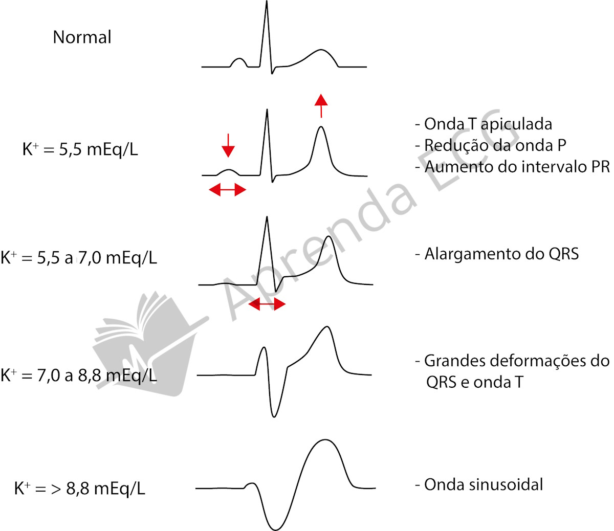 Hipercalemia e suas Alterações Eletrocardiográficas- Aprenda ECG