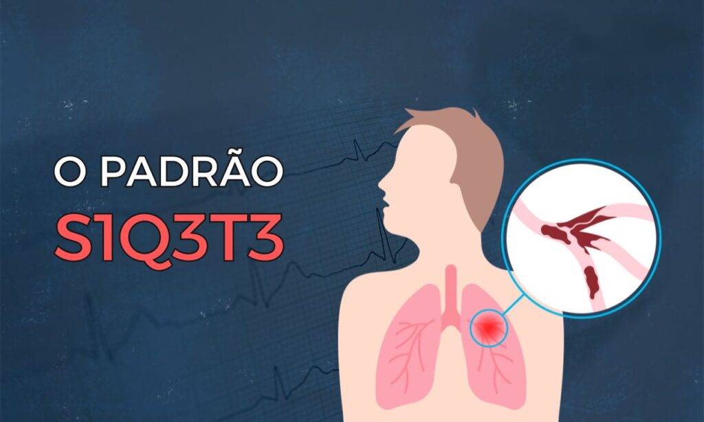 Padrão S1Q3T3: Qual a real importância desse achado? - Aprenda ECG
