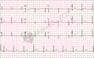 ECG Passo-a-Passo: Análise do Ritmo - Aprenda ECG